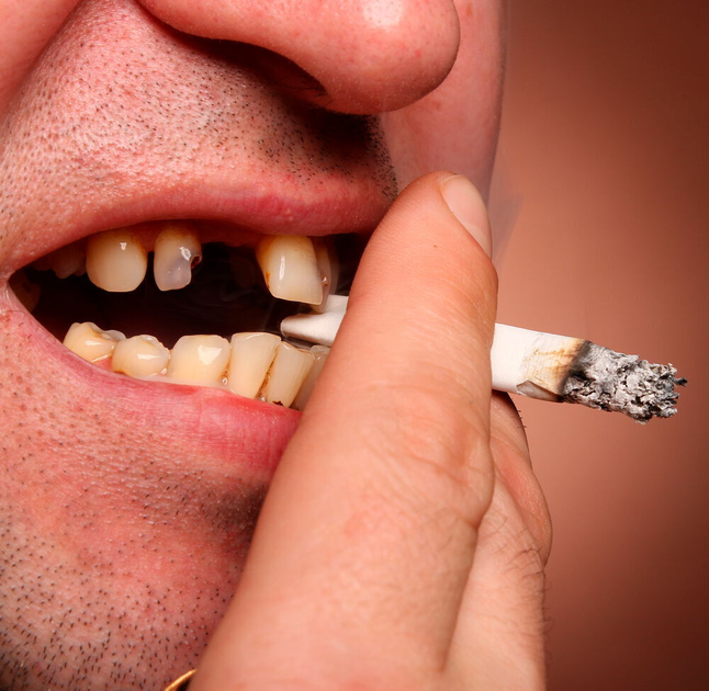 Studie belegt: Raucher schaden ihren Zähnen