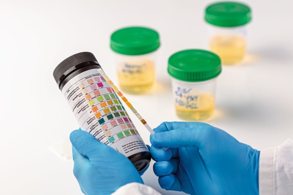 Urinscreening gibt Aufschluss über Krankheiten