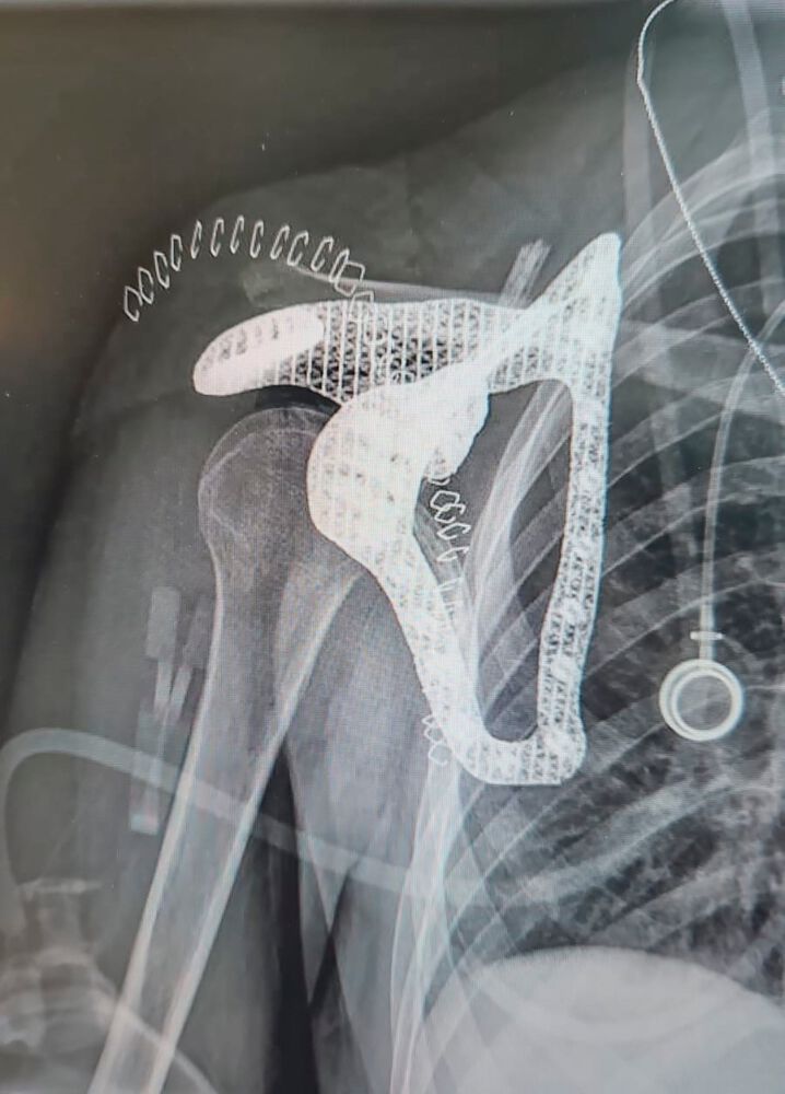 Engineering enables smart implants