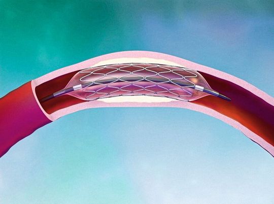 Was ist ein Stent? Operation, Risiken und Herstellung